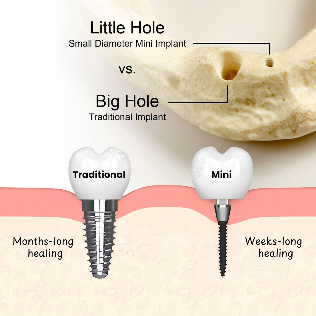 What Are the Benefits of Mini Implants vs. Traditional Implants?